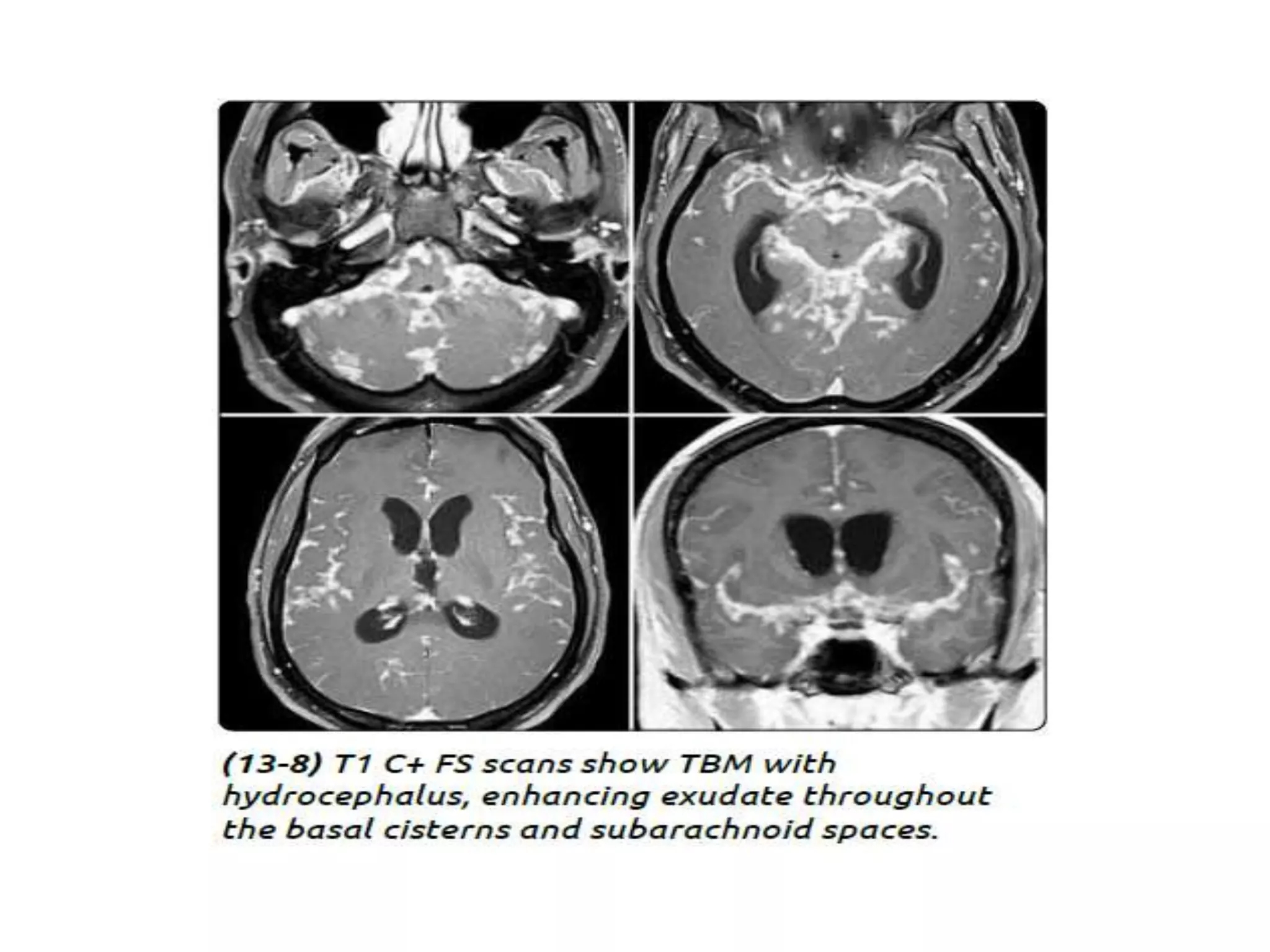 Imaging in CNS Infections | PPTX