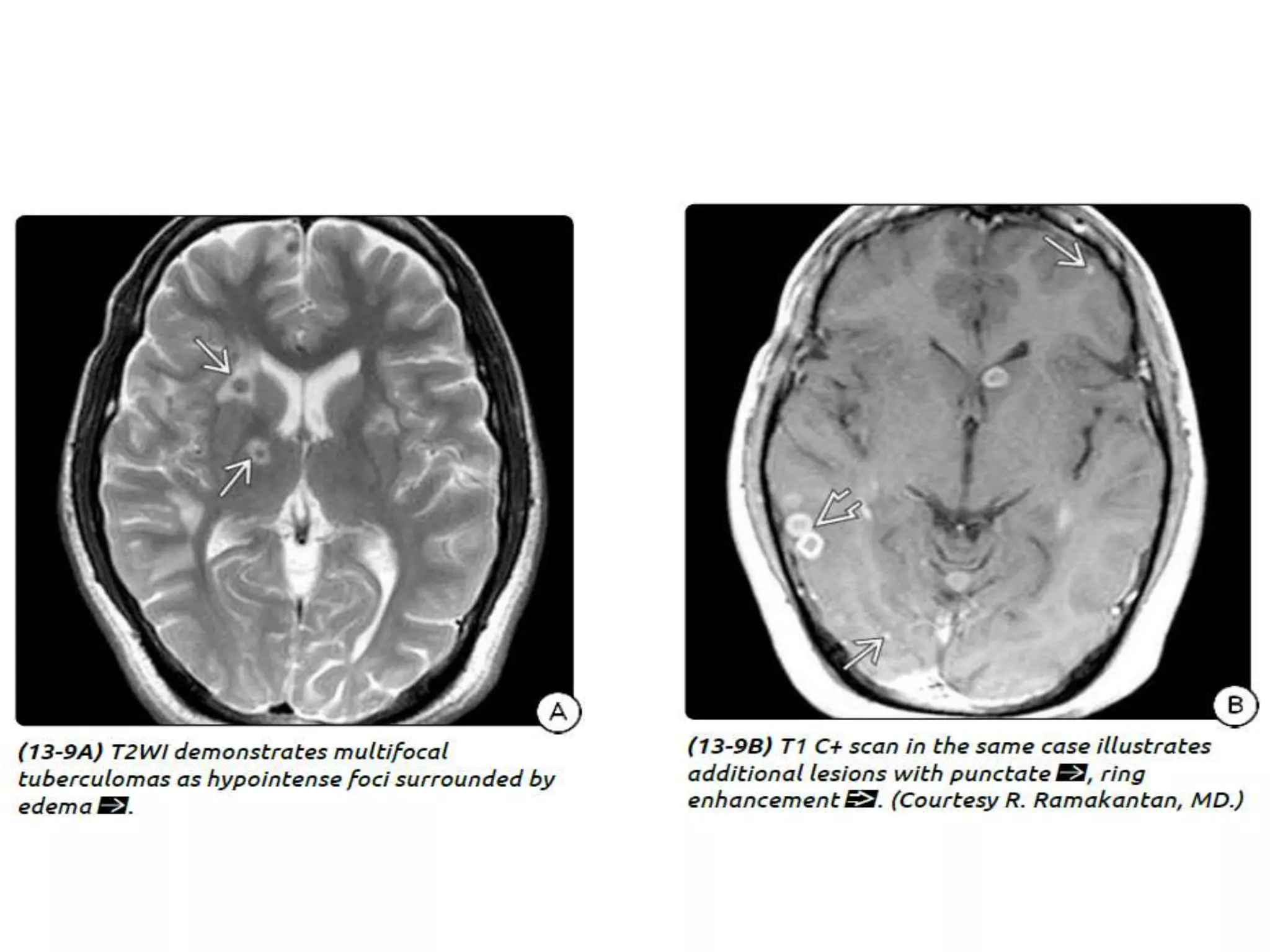 Imaging in CNS Infections | PPTX