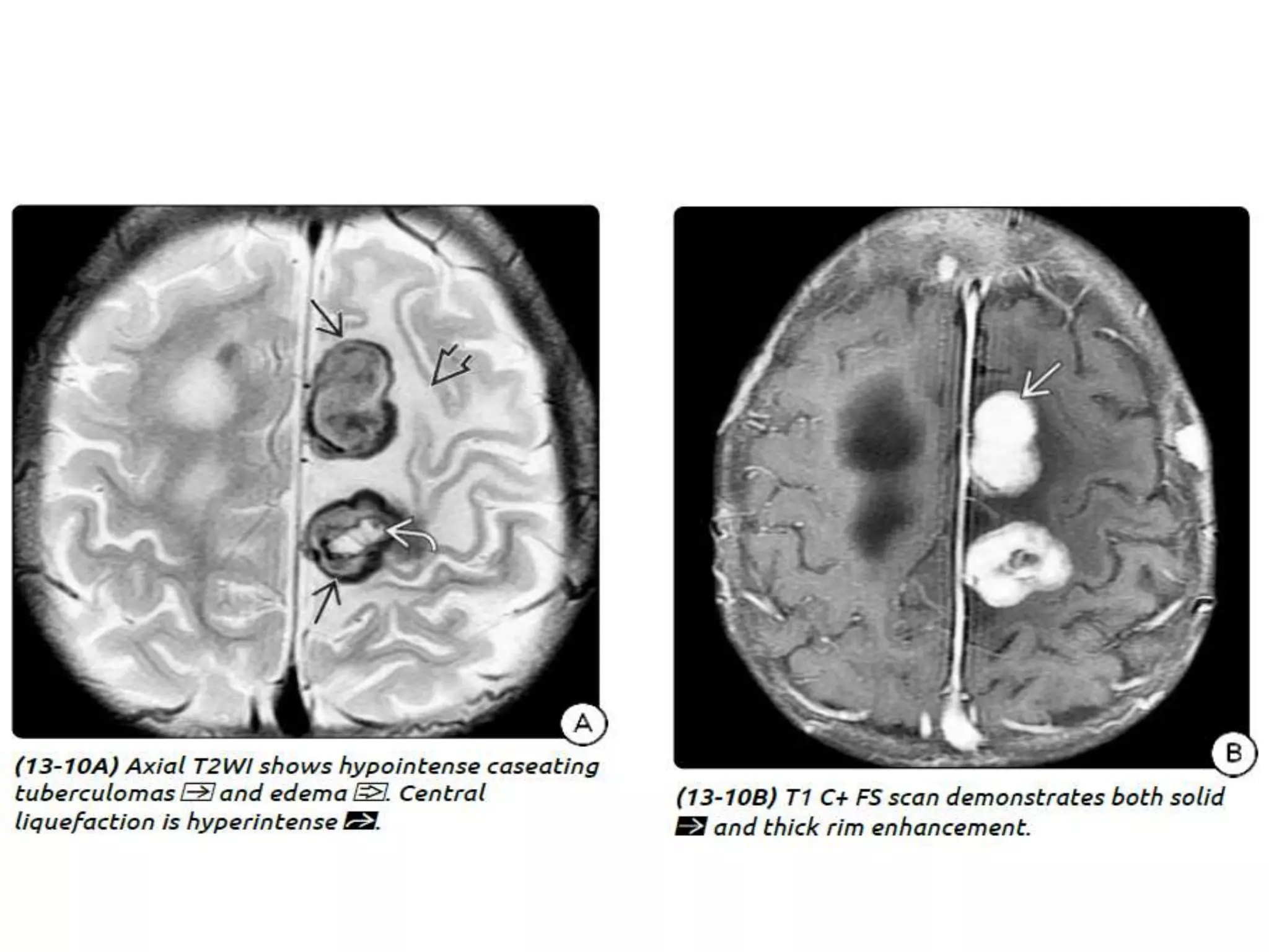 Imaging in CNS Infections | PPTX