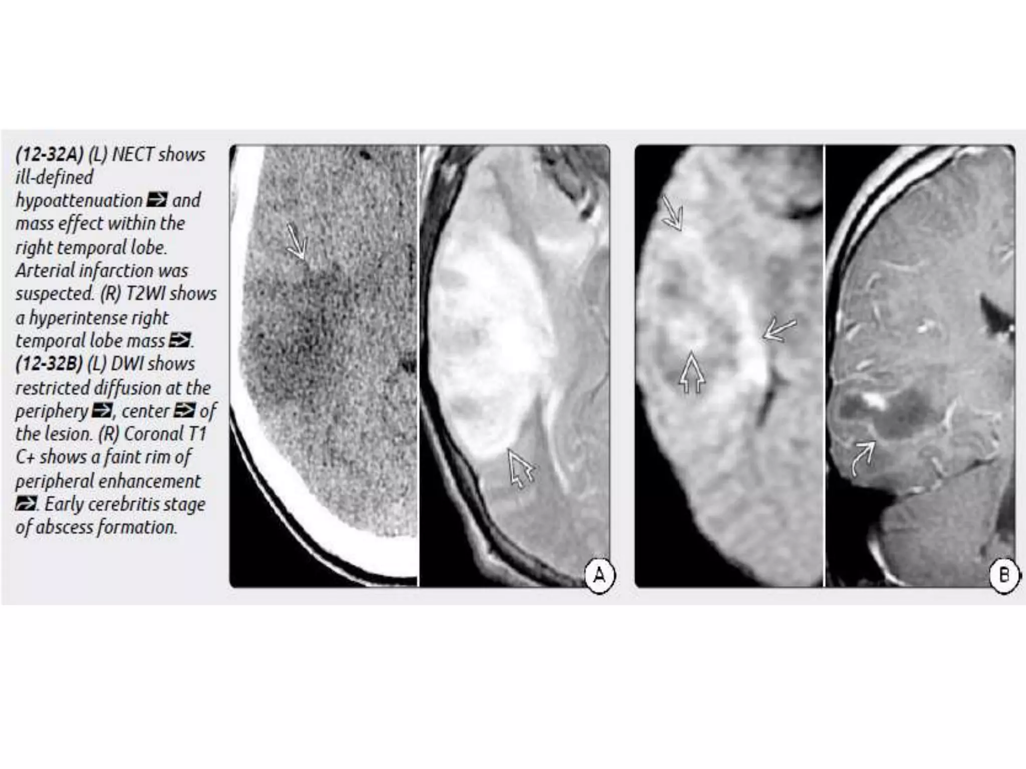 Imaging in CNS Infections | PPTX