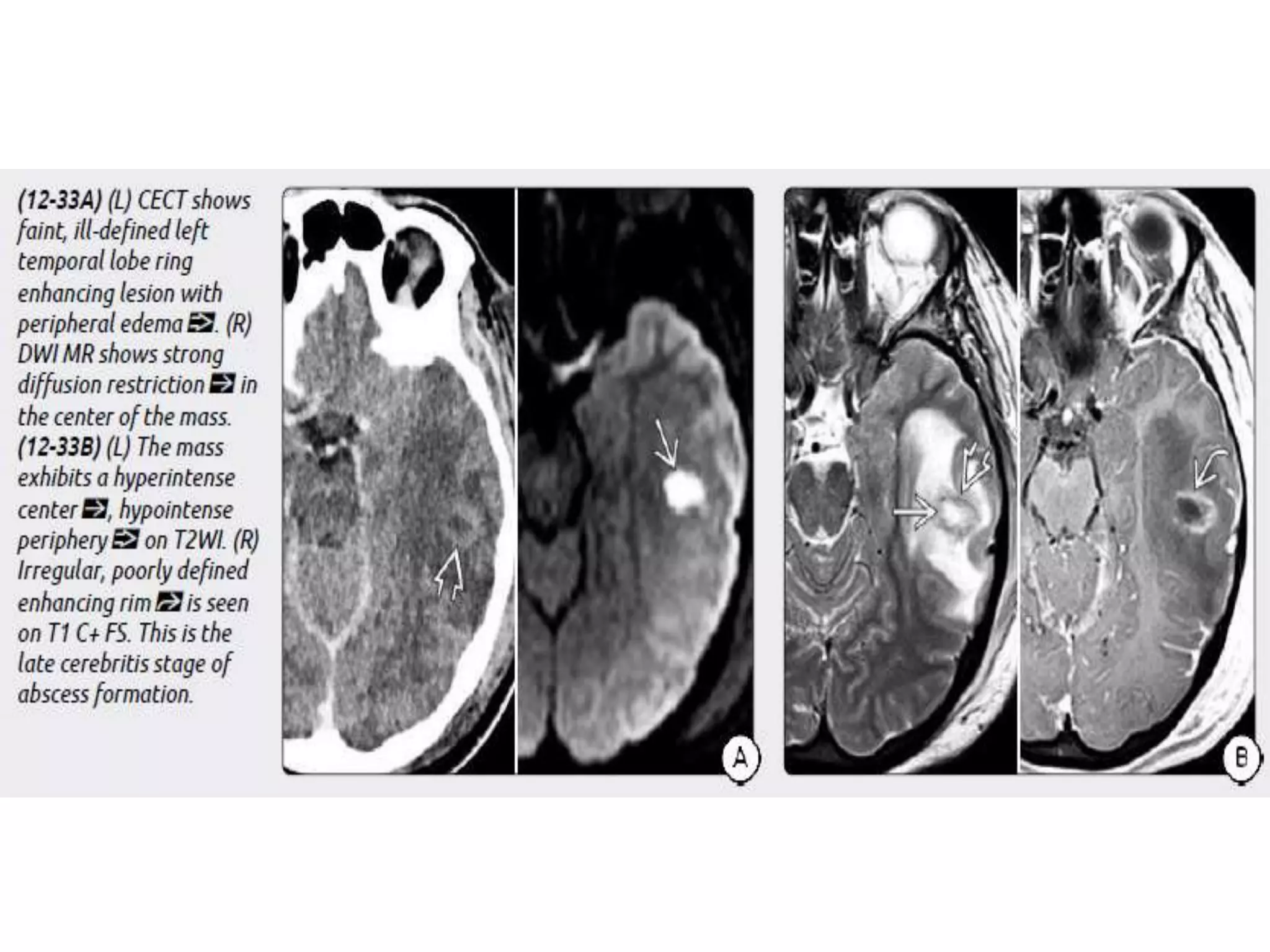 Imaging in CNS Infections | PPTX