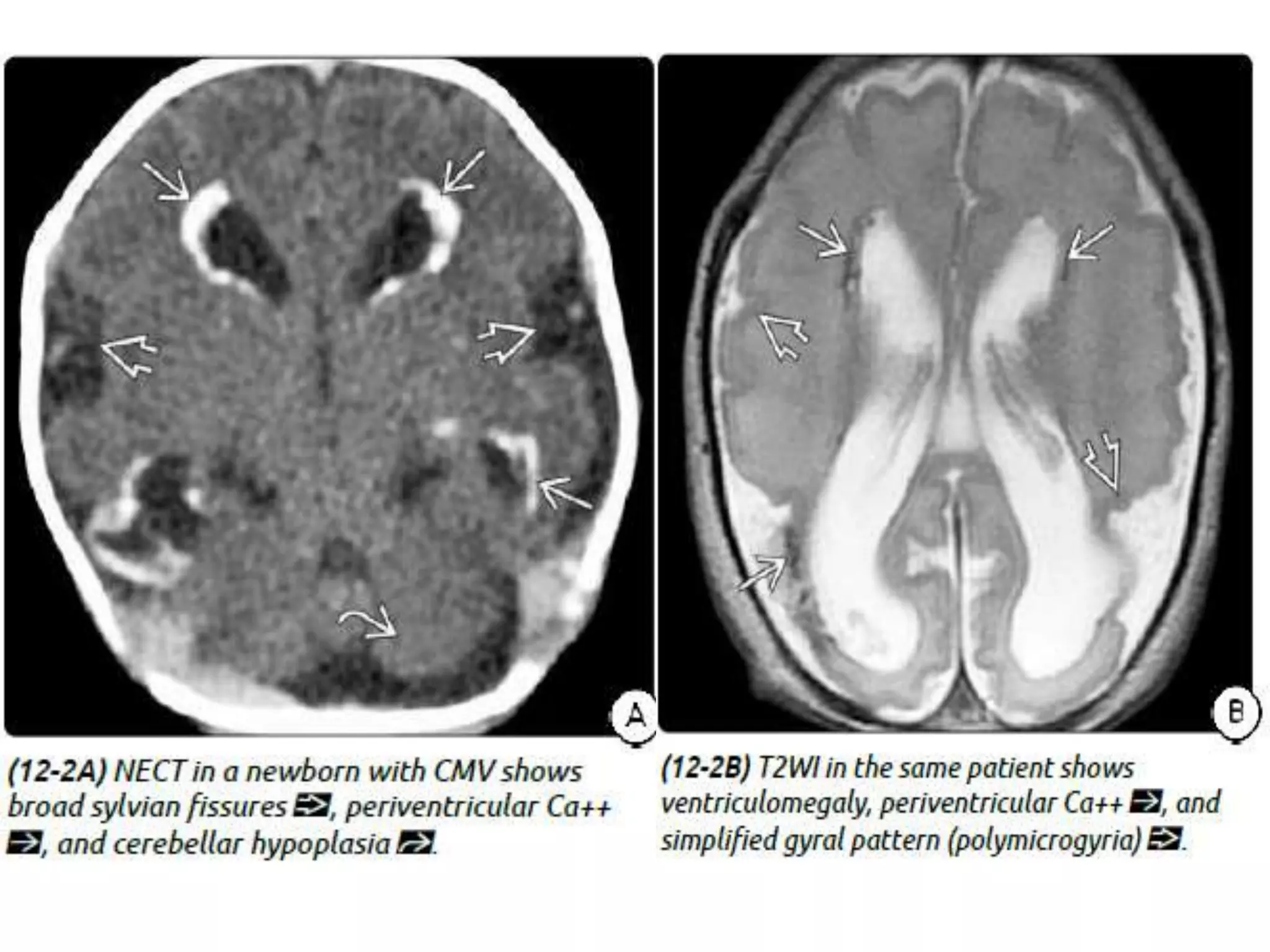 Imaging in CNS Infections | PPTX