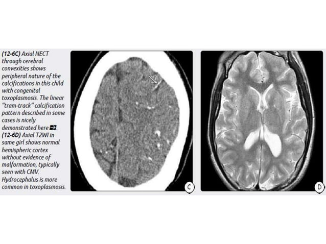 Imaging in CNS Infections | PPTX