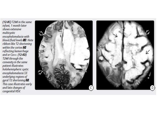 Imaging in CNS Infections | PPTX