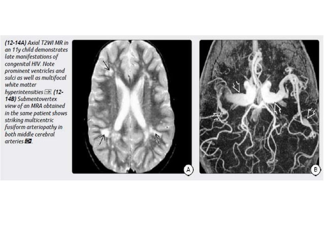 Imaging in CNS Infections | PPTX