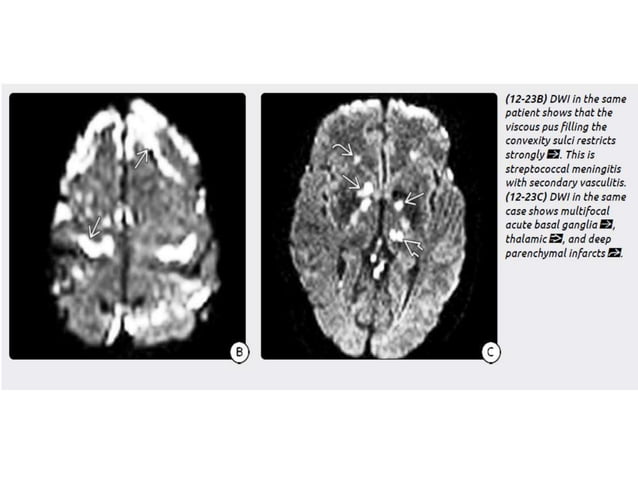 Imaging in CNS Infections | PPTX