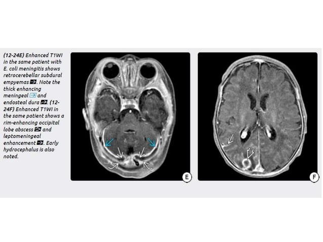 Imaging in CNS Infections | PPTX