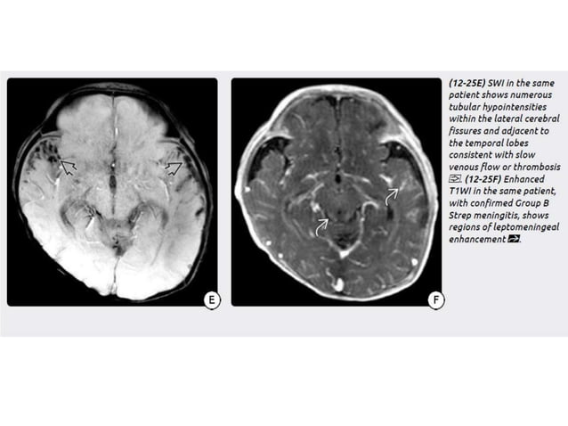 Imaging in CNS Infections | PPTX