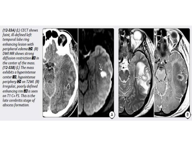 Imaging in CNS Infections | PPTX