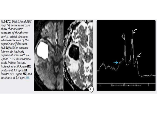 Imaging in CNS Infections | PPTX