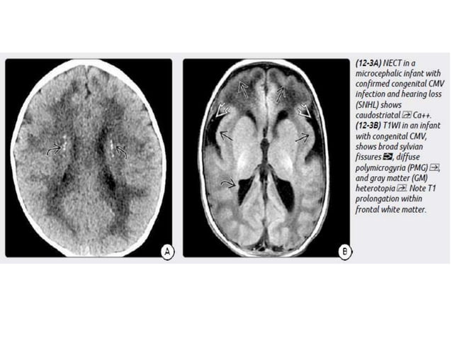 Imaging in CNS Infections | PPTX