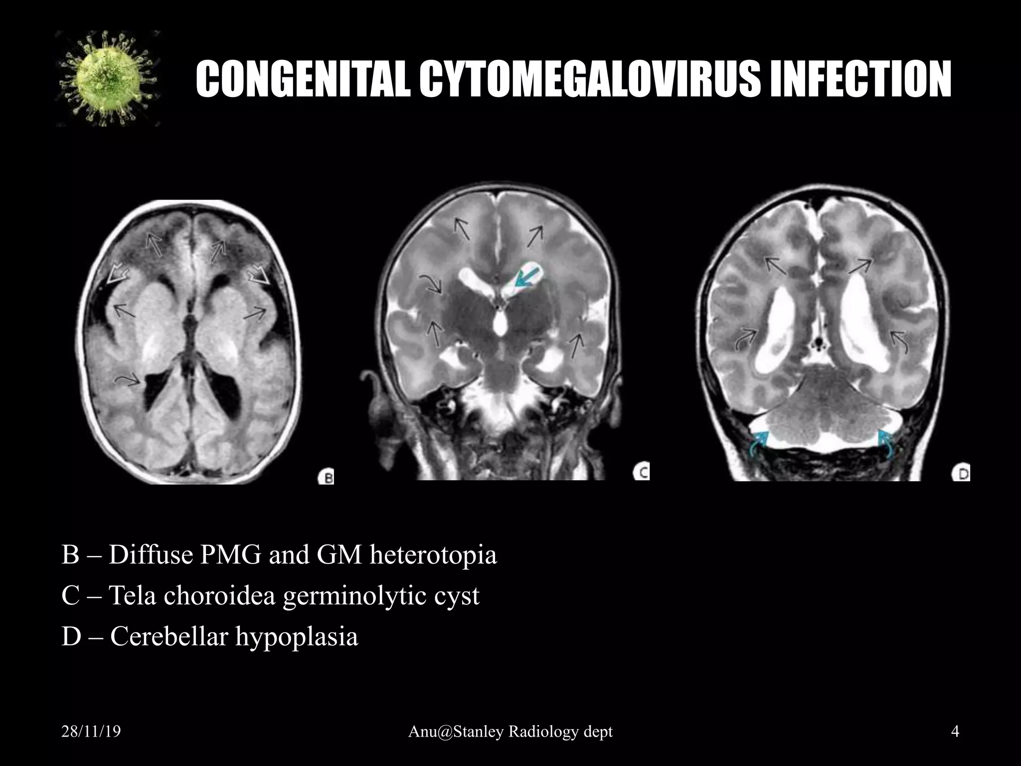 Cns Infections congenital, pyogenic & viral - Imaging | PPTX