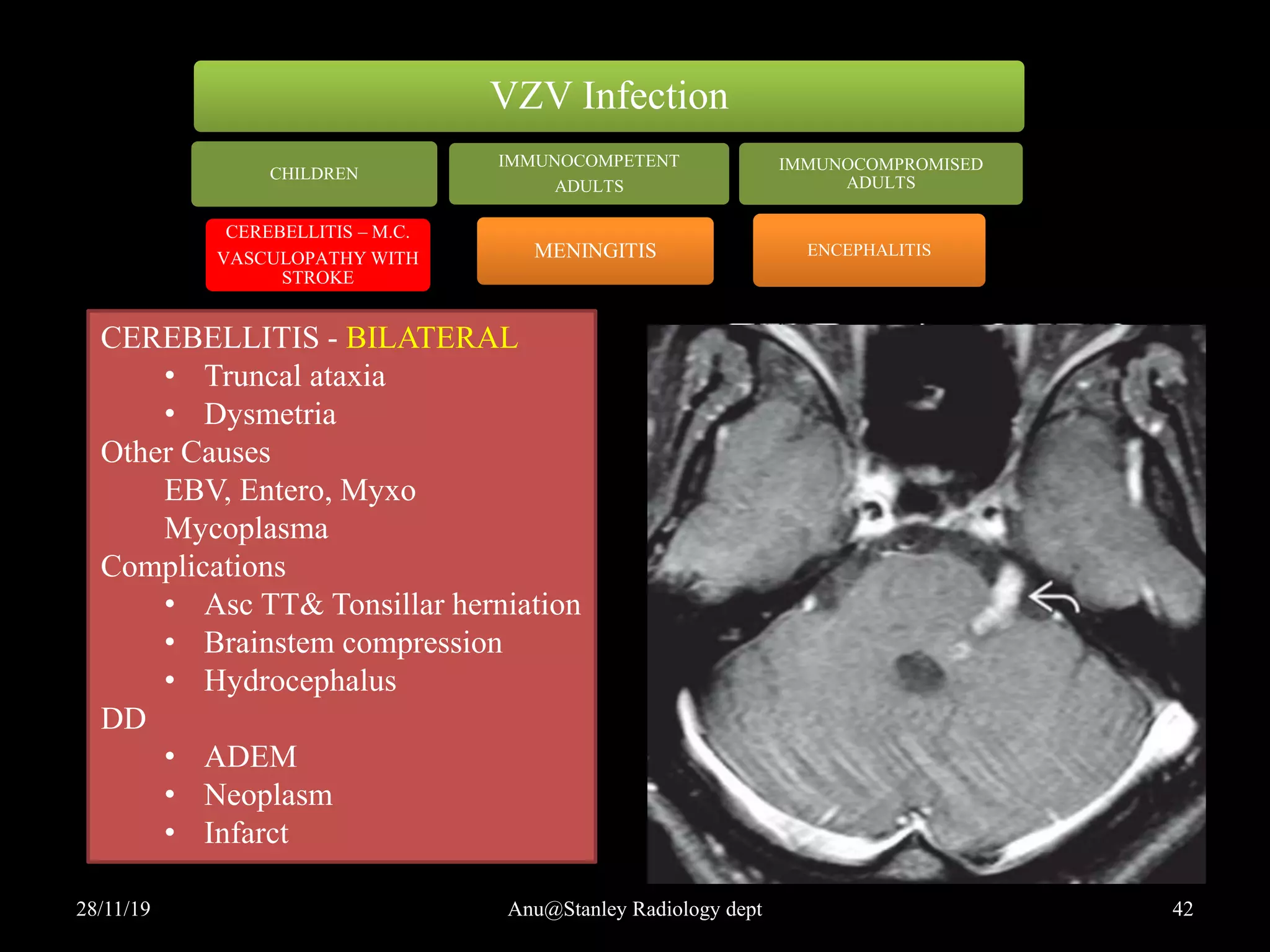 Cns Infections congenital, pyogenic & viral - Imaging | PPTX