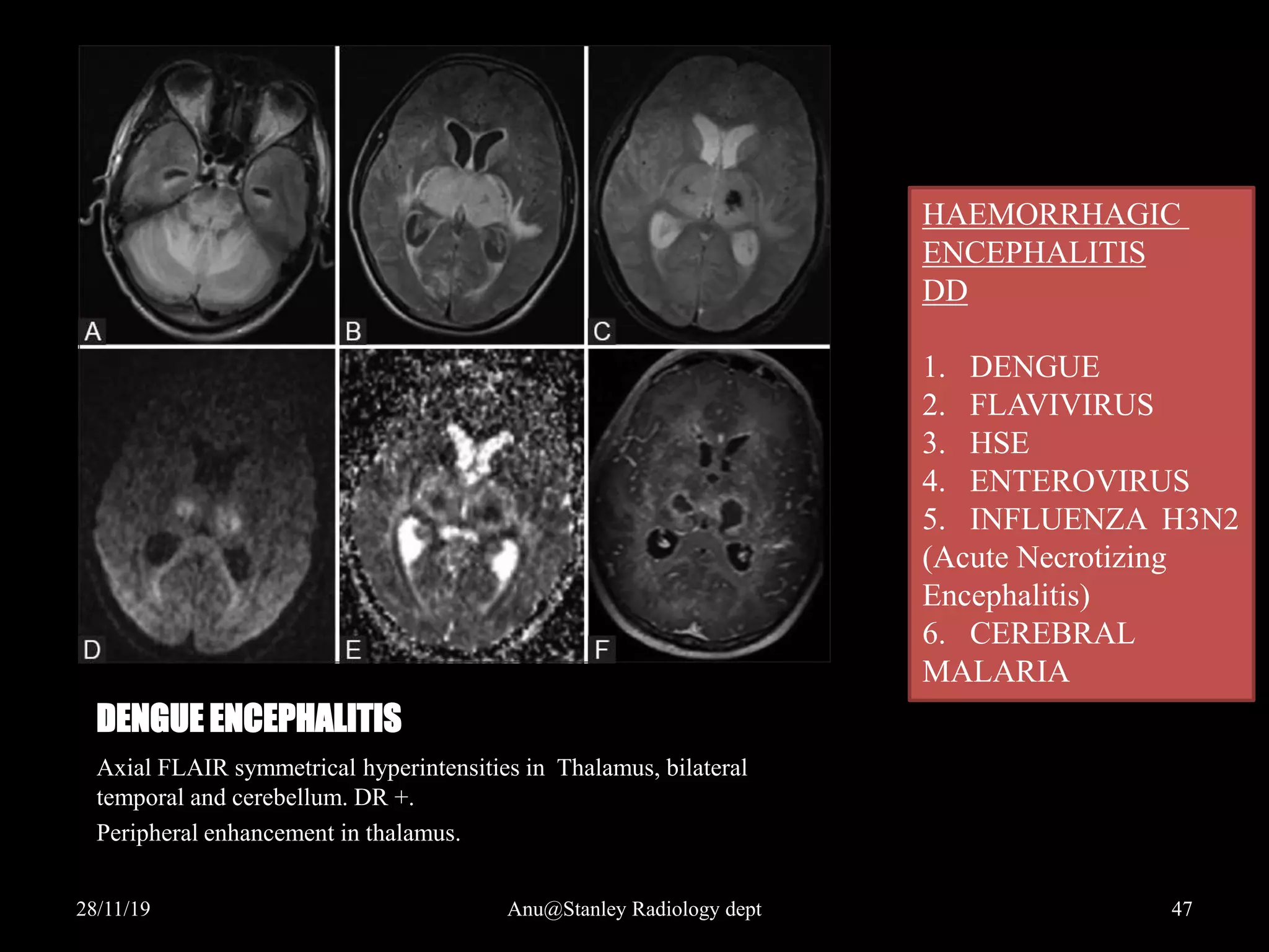 Cns Infections congenital, pyogenic & viral - Imaging | PPTX