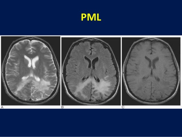 CNS infections in HIV