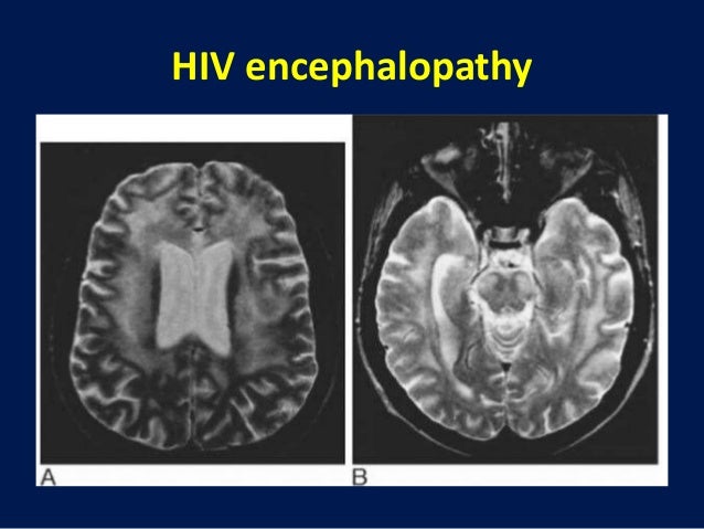 CNS infections in HIV
