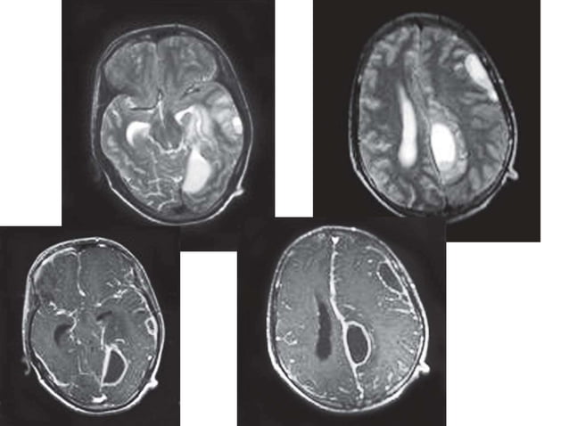 Cns infections perfect | PPTX | Brain and Nervous System Disorders ...