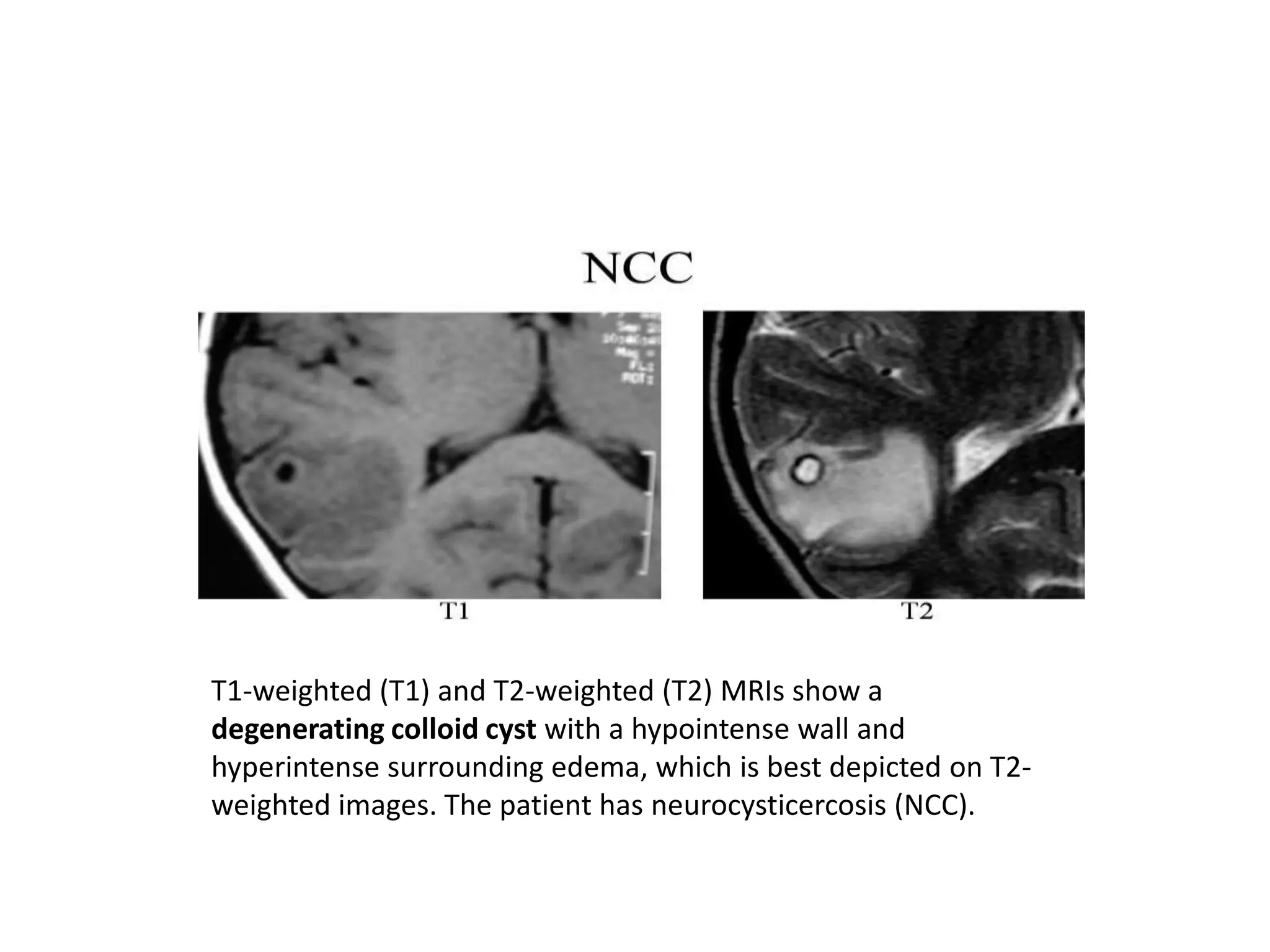 Cns infections radiology. | PPTX