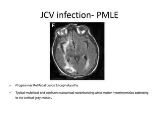 Cns infections radiology. | PPTX