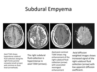 Cns infections radiology. | PPTX