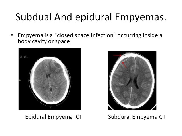 Cns infections radiology.