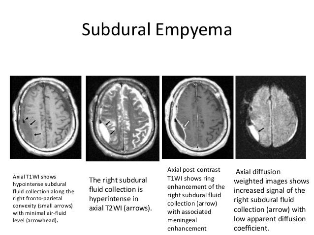 Cns infections radiology.