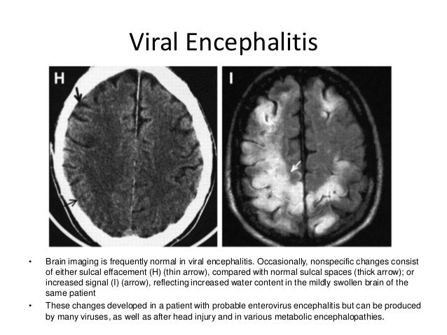 Cns infections radiology.
