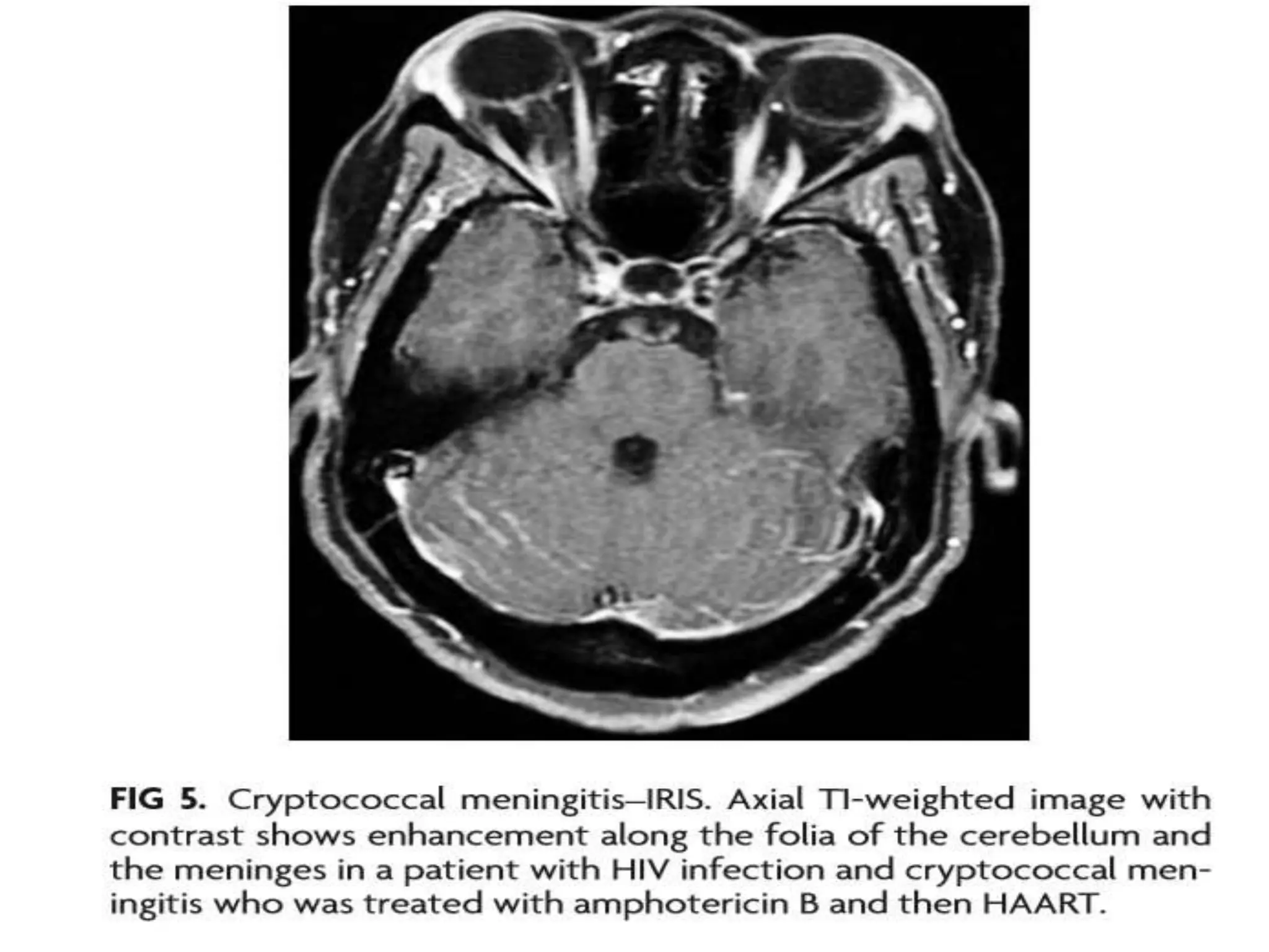 CNS IRIS.pptx