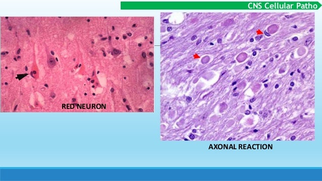 Central nervous system pathology