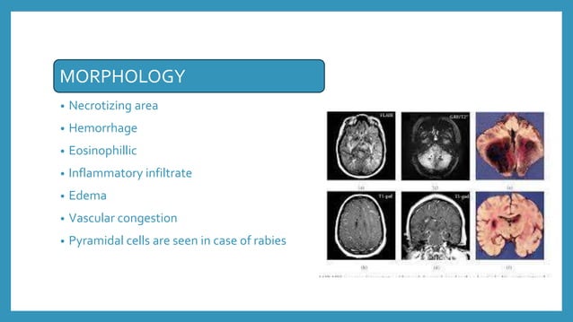 Hydrocephalus, meningitis and encephalitis - Pathology | PPTX