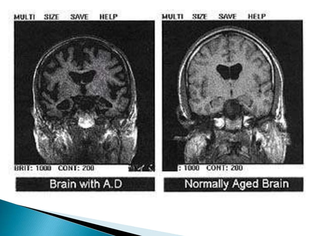 CNS Response To Injury | PPT