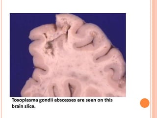 Toxoplasma Gondii Brain Abscess