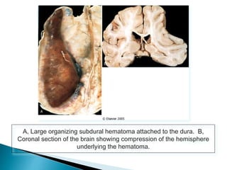 CNS Trauma | PPTX