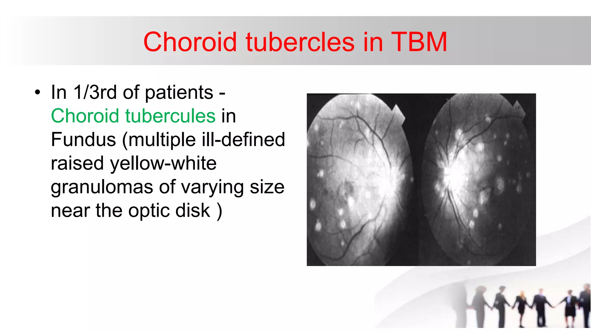 Cns tuberculosis | PPTX