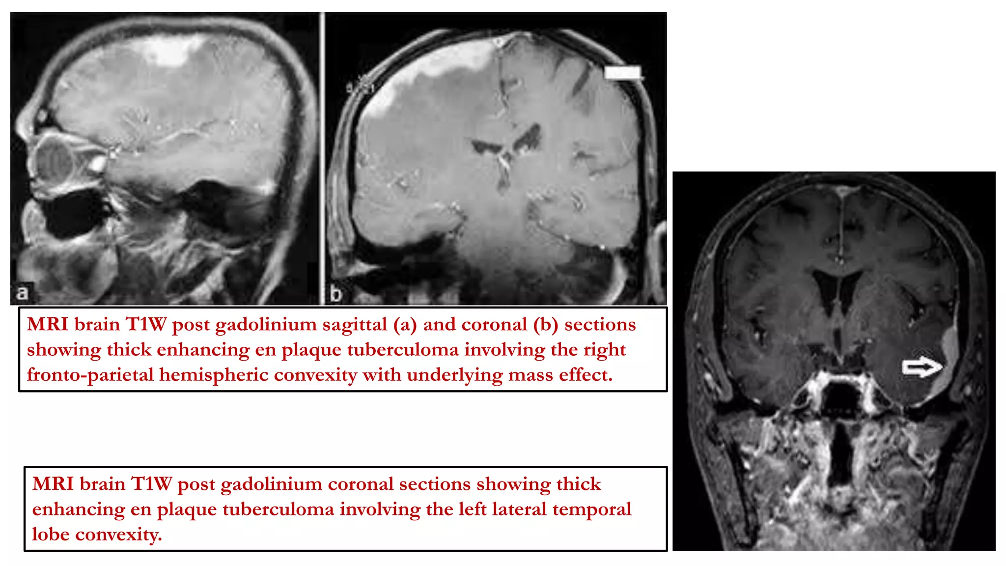 Tuberculosis of the Central Nervous system | PPTX