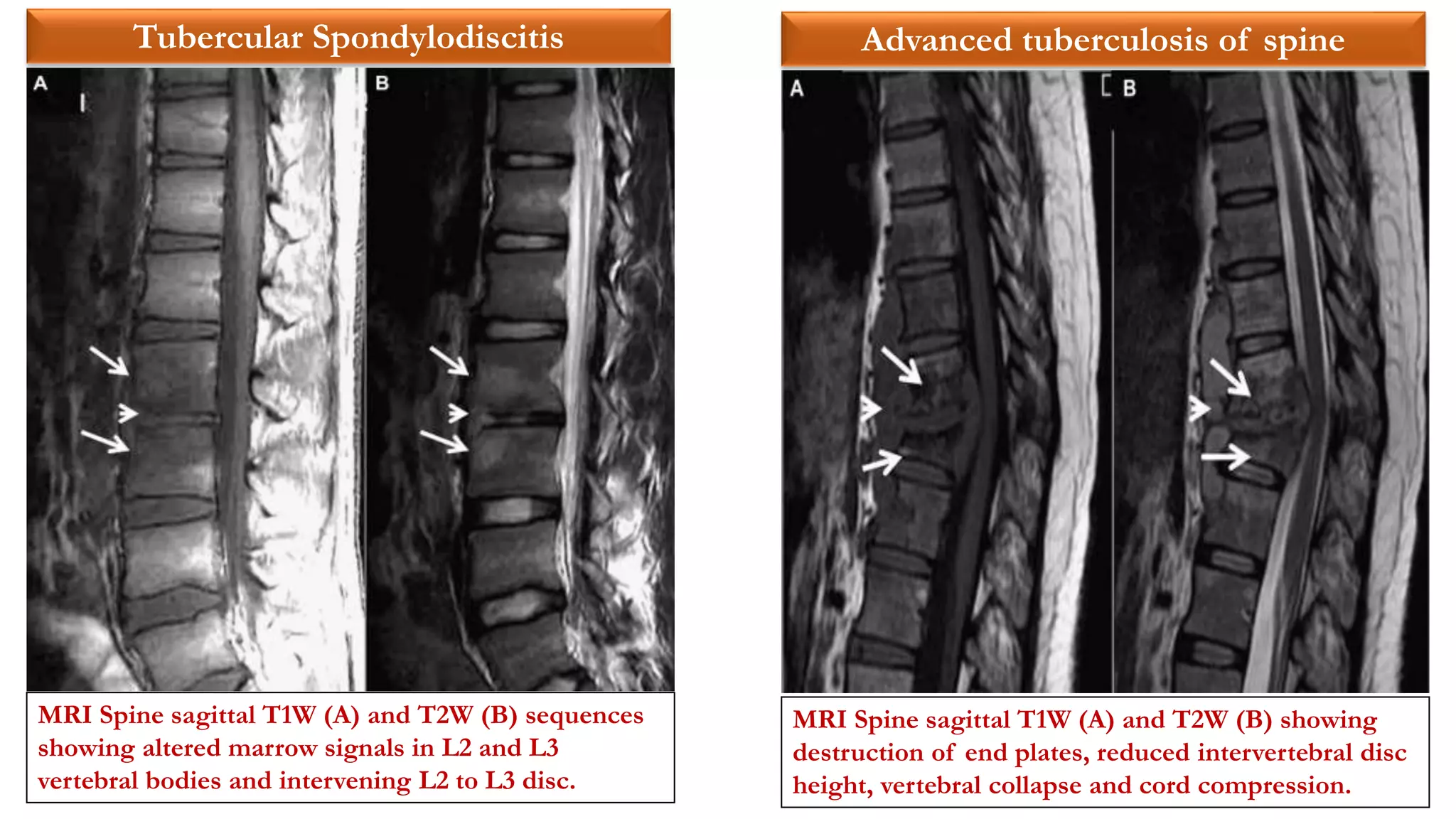 Tuberculosis of the Central Nervous system | PPTX