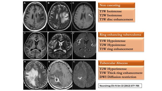 Tuberculosis of the Central Nervous system | PPTX