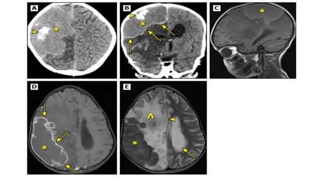CNS TUBERCULOSIS.pptx