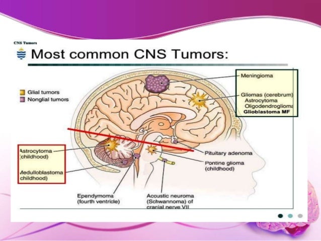 Cns tumor, gliomas