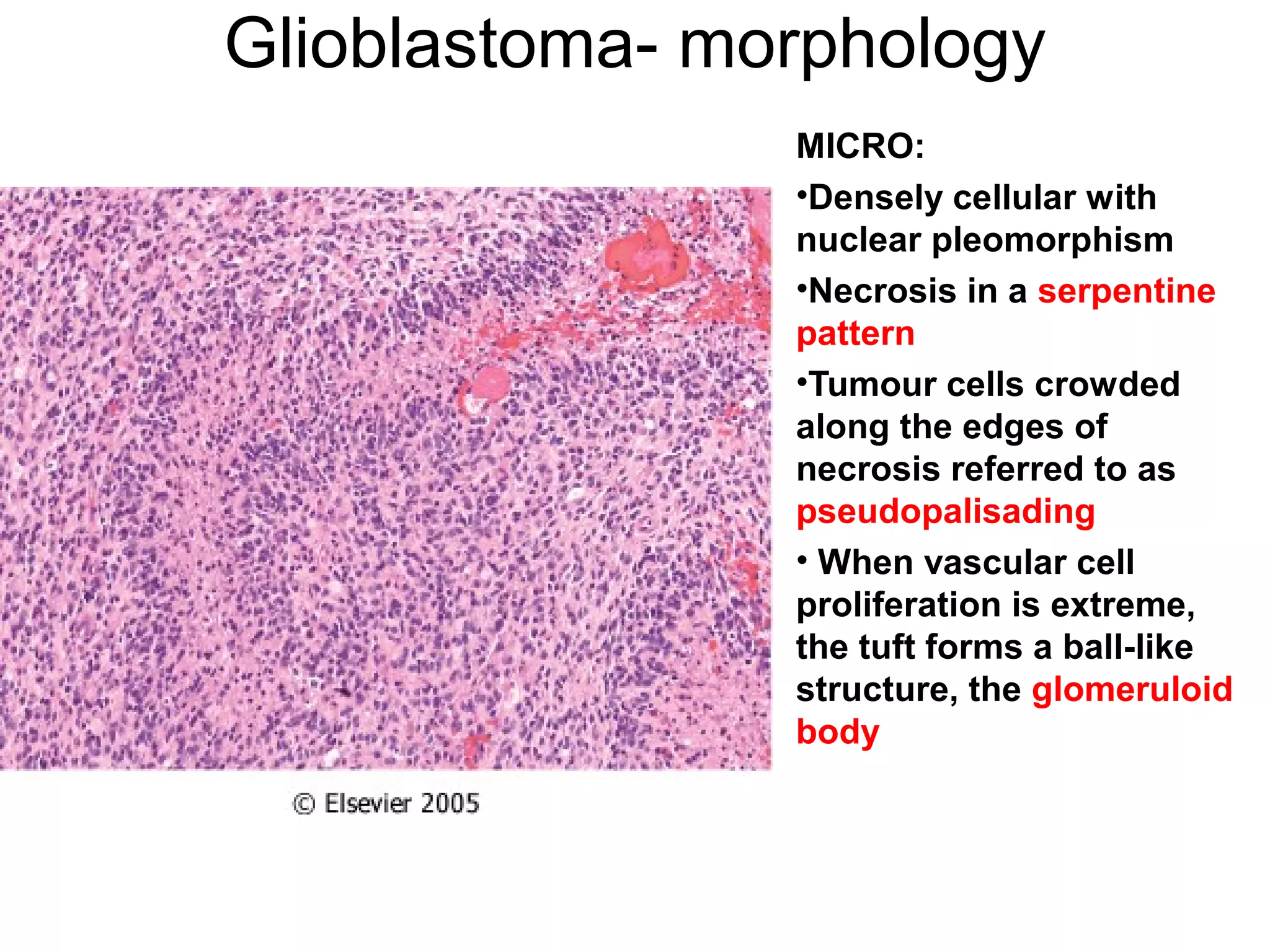 Cns tumors | PPT