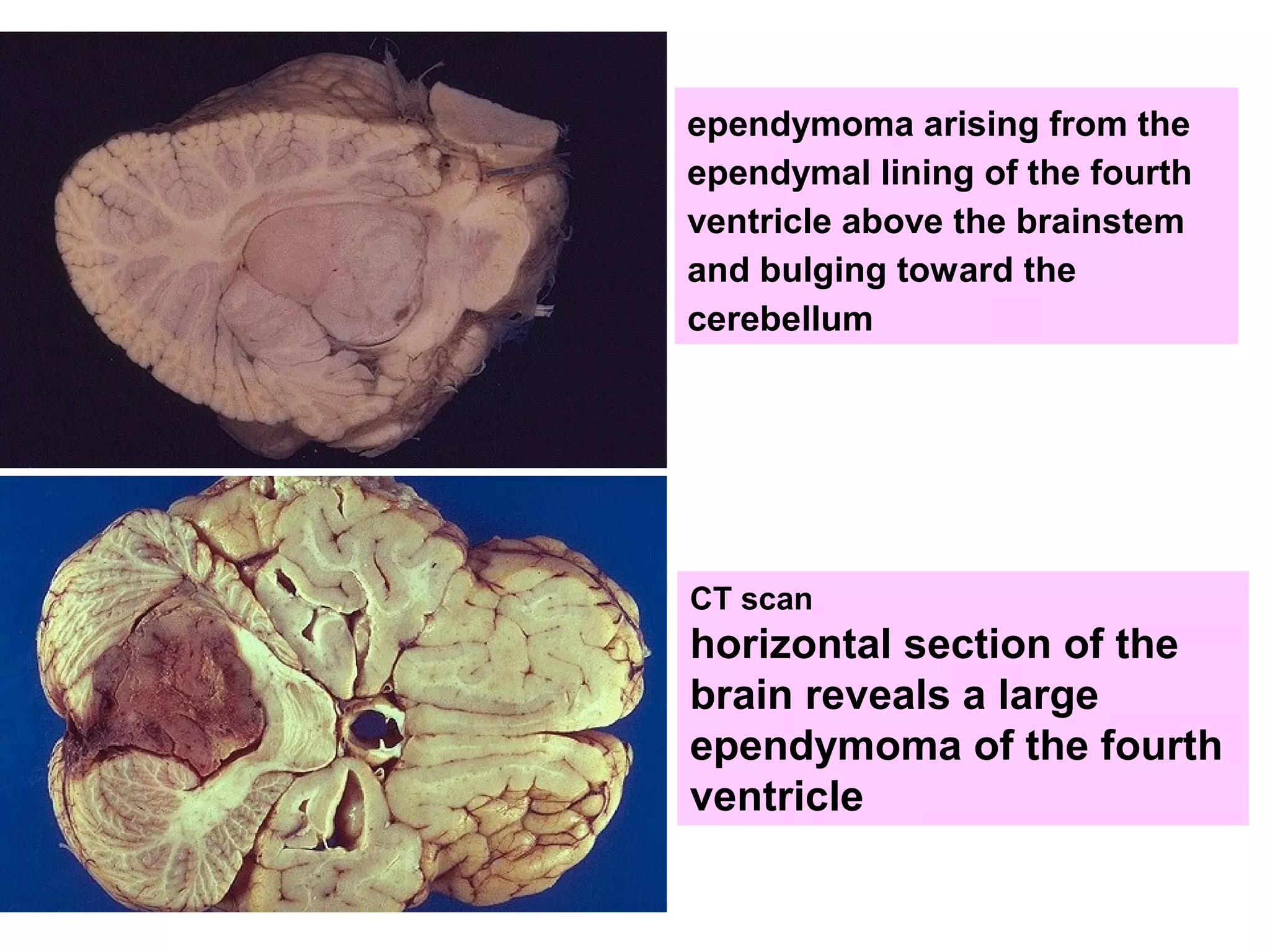 Cns tumors | PPT