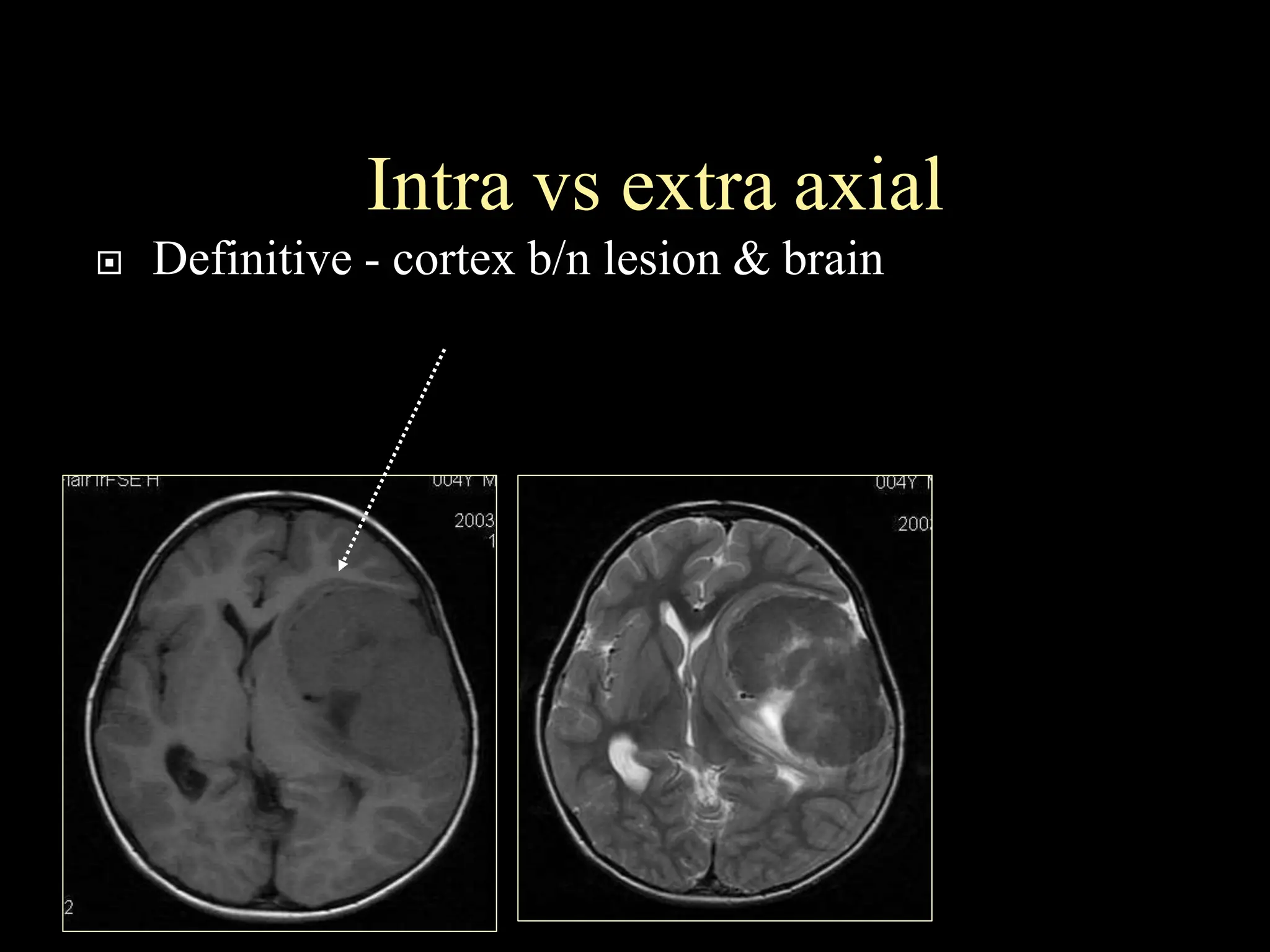 cns tumors and differentiation by imaging modalities .pptx