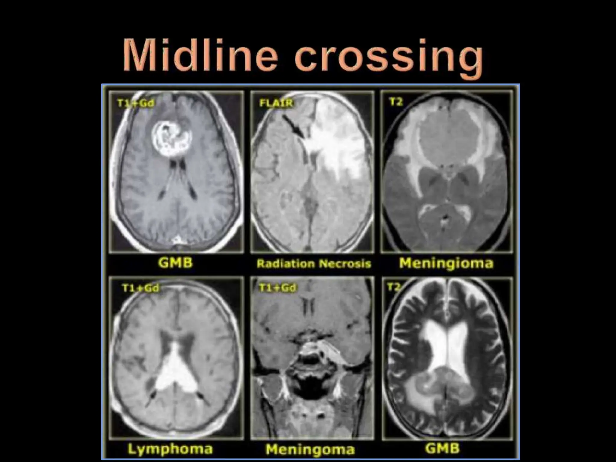 cns tumors and differentiation by imaging modalities .pptx