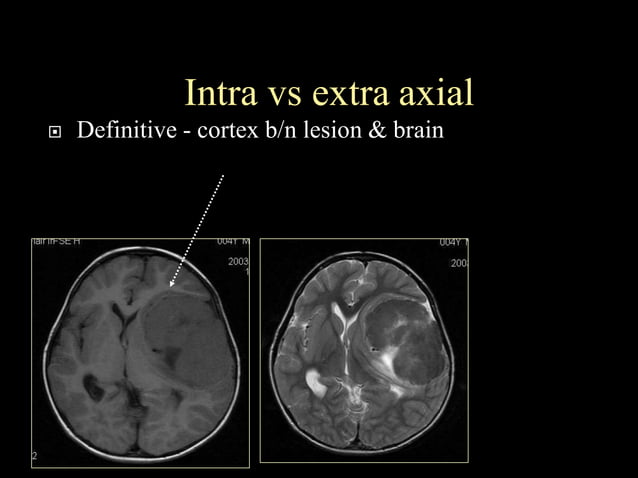 cns tumors and differentiation by imaging modalities .pptx