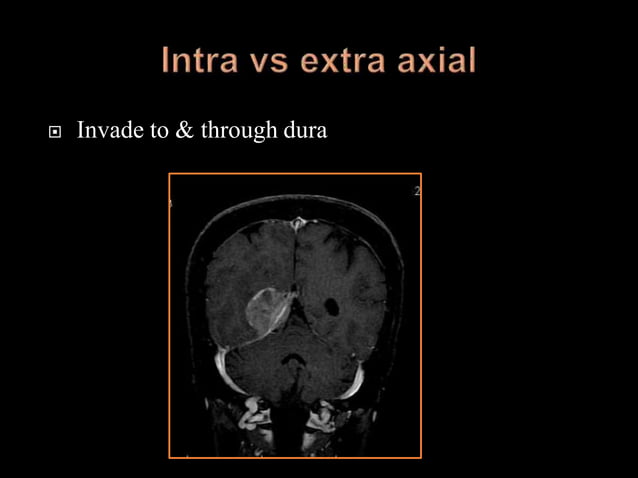 cns tumors and differentiation by imaging modalities .pptx