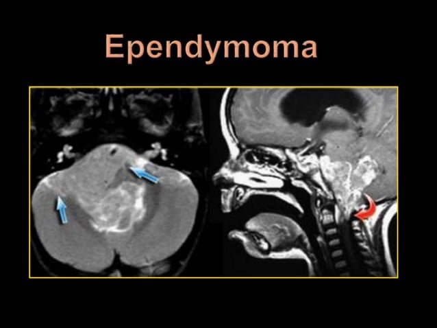 cns tumors and differentiation by imaging modalities .pptx