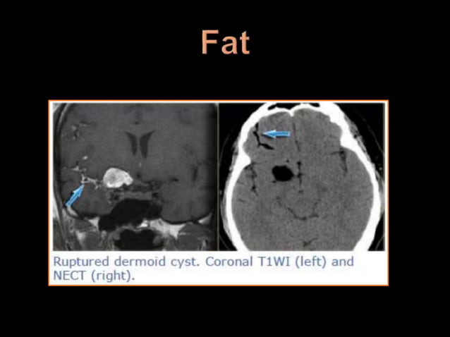 cns tumors and differentiation by imaging modalities .pptx