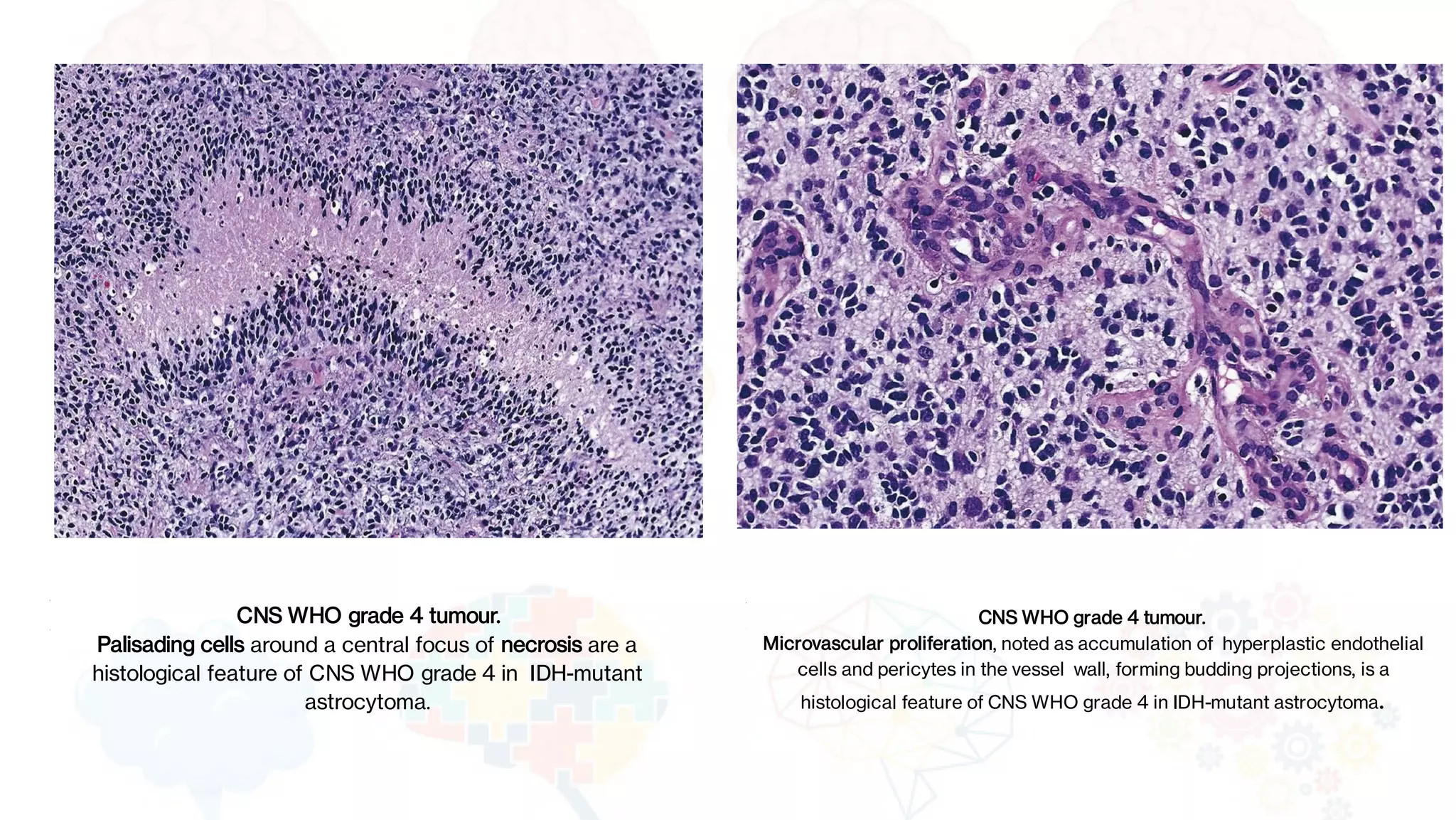 CNS TUMORS WITH UPGRADES(1).pdf