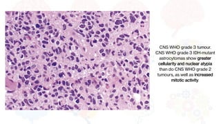 CNS TUMORS WITH UPGRADES(1).pdf
