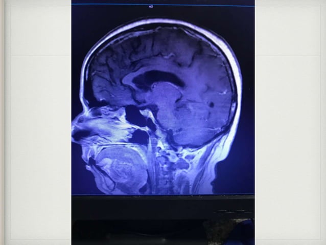 Cns Vasculitis Primary Vs Secondary Ppt